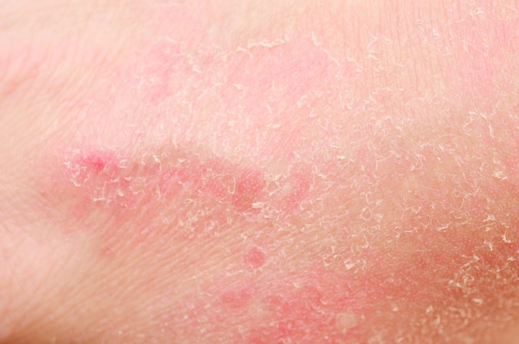 The Effects of Tanning on Prescription Medications | Broad Ripple Tans